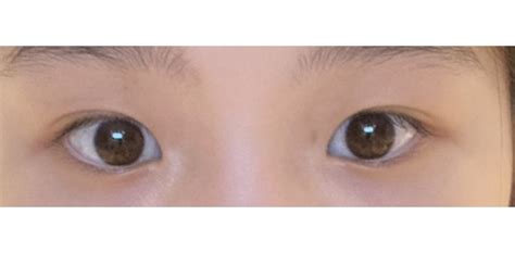 리얼후기 4 페이지 눈이 예쁘다 그래서 아몬드성형외과