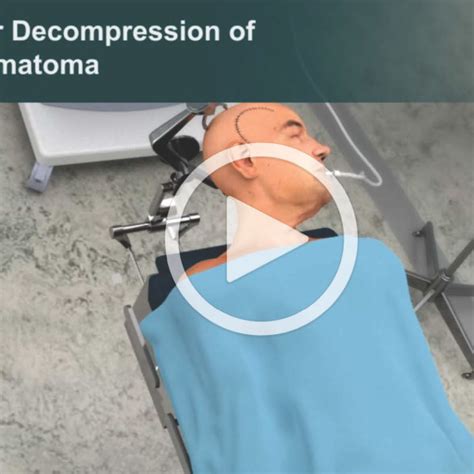 Intraventricular Hemorrhage Ivh Trial Exhibits Inc