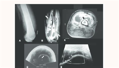 Osteomyelitis Due To Direct Implantation In A Patient Download