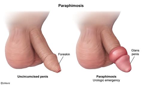Paraphimosis Male Reproductive System Uworld Medical Library