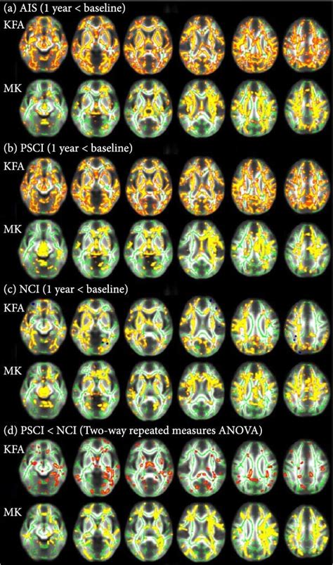 Longitudinal Alterations In Wm Tract Integrity Cluster In Which Less
