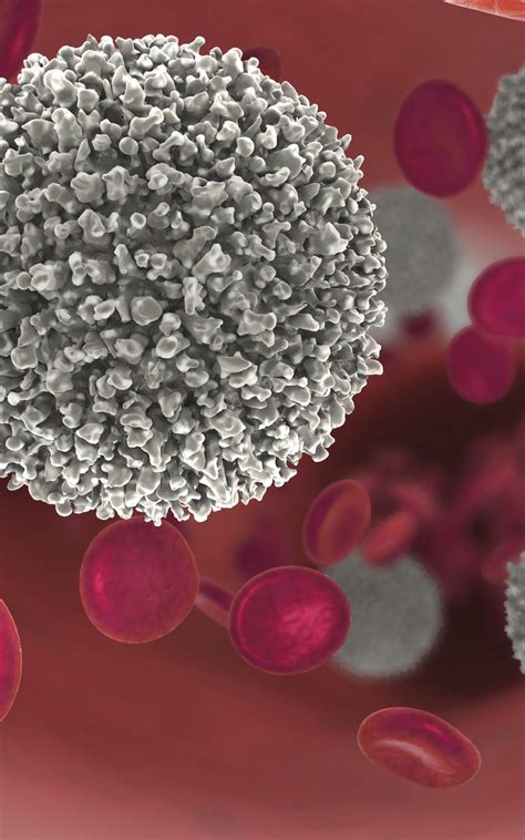 Leucemia Fulminante Qual è La Causa Come Si Manifesta Cosa Si Può Fare