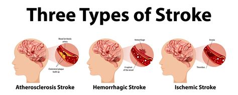Types Of Ischemic Stroke