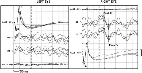 Flash Visual Evoked Potentials Veps And Electroretinogram Erg Erg Download Scientific