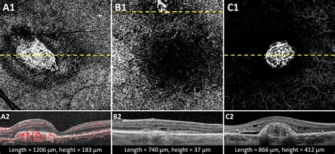 The Diagnostic Accuracy Of Double Layer Sign In Detection Of Macular Neovascularization