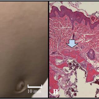 A Representative Image Of The Subcutaneous Lesions That Were Download Scientific Diagram