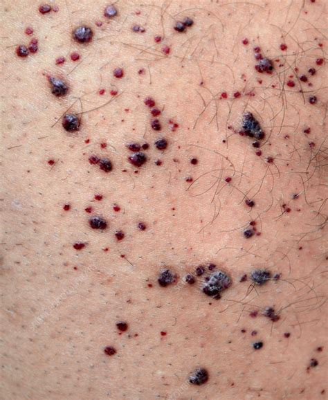 Angiokeratoma