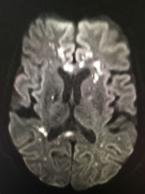 Embolic Infarcts Artofit