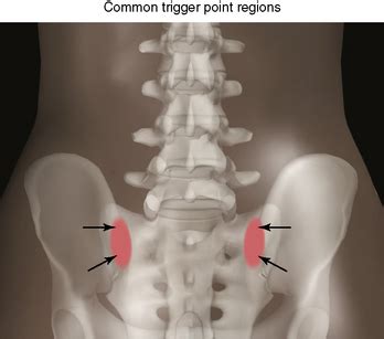 Trigger Point Injection Basicmedical Key