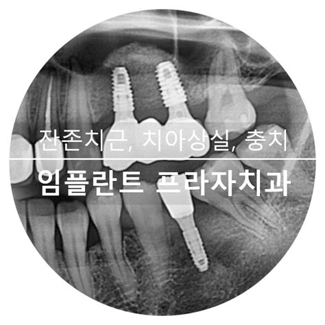 광교 수원 임플란트 잔존치근 발치 치아상실 부위 오스템 임플란트 상악동거상술 뼈이식 다수 치아 충치치료 신경치료 크라운 네이버 블로그