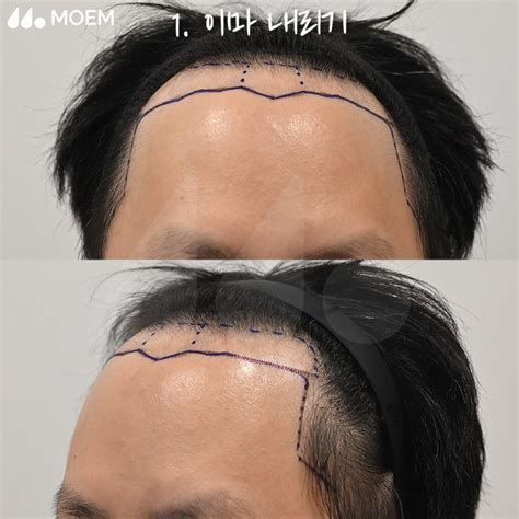 M자탈모 높은 이마 내리기 모발이식 노하우 히든컷 4000모 디자인 네이버 블로그
