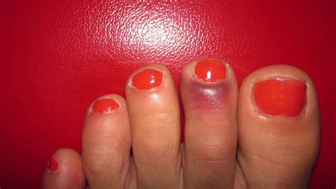 Nice Info About How To Fix A Jammed Toe Welfareburn