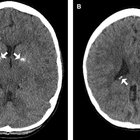 Axial Computed Tomography Ct Brain Imaging A Bilateral Globus Download Scientific Diagram