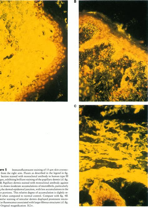 Figure 2 From Unilateral Microfibrillar Abnormalities In A Case Of