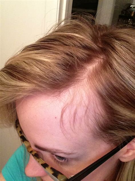 Hey Guys Pretty Sure I Have Diffuse Alopecia Areata Alopecia World