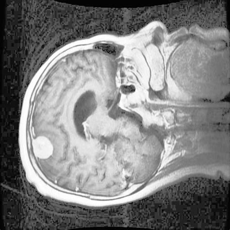 Tumor Otak Object Detection Dataset And Pre Trained Model By Gunadarma University
