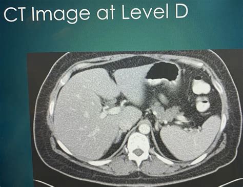 Ct Abdomen Level D Diagram Quizlet