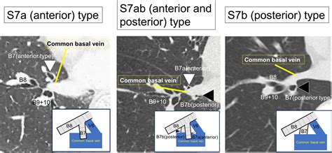 Thoracoscopic Anatomic Segmentectomy Techniques For Rare Medial Basal Segment S7 Variants