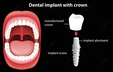 Vektor Medis Klip Elemen Gigi Implan Gigi Vektor Gigi Elemen Klip