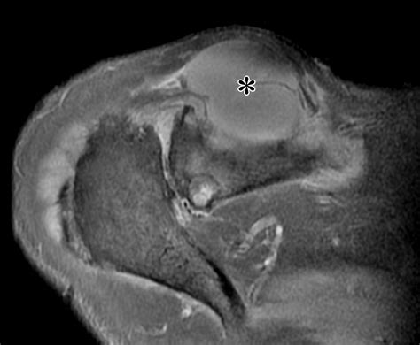 Imaging Of The Acromioclavicular Joint Anatomy Function Pathologic Features And