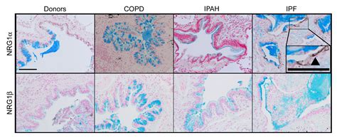 Ectopic Respiratory Epithelial Cell Differentiation In Bronchiolised Distal Airspaces In