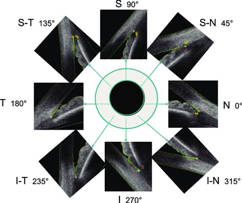 Schematic Explanation Of The Eight Iridotrabecular Angle Sections Under