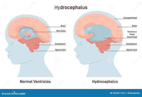 Hydrocephalus Brain With Cerebrospinal Fluid Neurological Condition