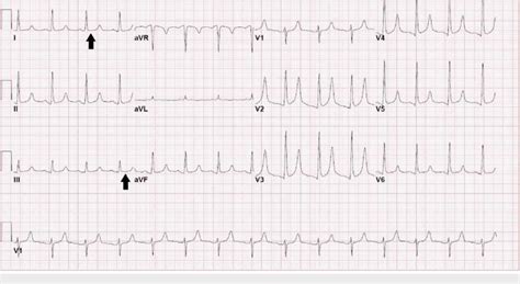 Electrocardiogram Showing Prolonged Qt Interval Black Arrows Download Scientific Diagram
