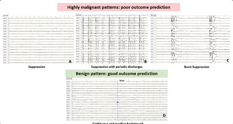 Grand Mal Aanval Eeg