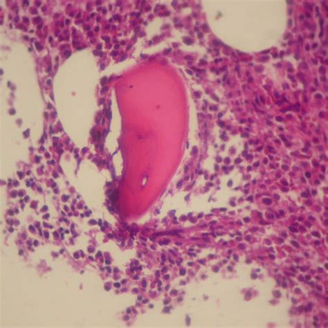 Cd138 Plus Plasmocytes Download Scientific Diagram