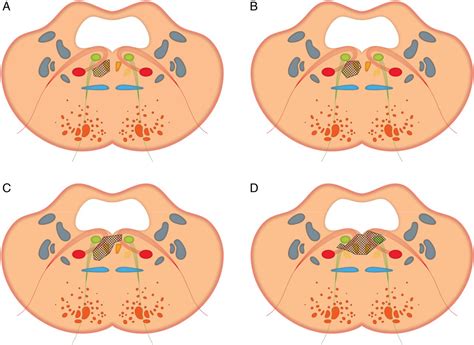 Medial Pontine Syndrome