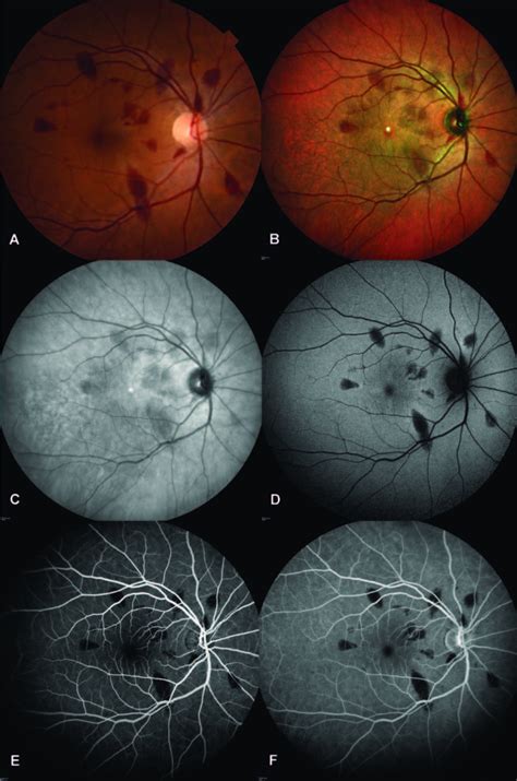 Multimodal Retinal Imaging At Presentation Fundus Image Displaying Download Scientific Diagram