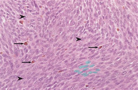 Choroidal Melanoma Pathology