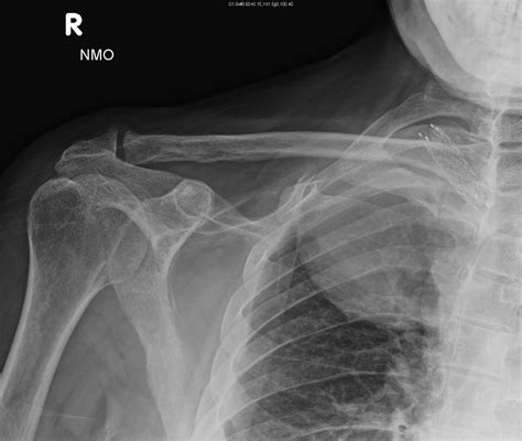 A Case Report Of A Ruptured Subclavian Artery Aneurysm Presenting To