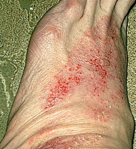 Straddling Realities Morgellons The Disease That Doesnt Exist But Does