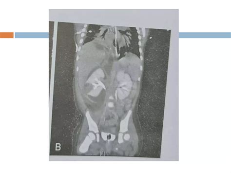 Case Presentation Of Pyelonephritis Pptx