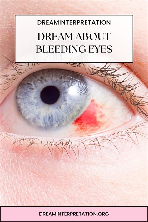 Bleeding Eyes Dream Interpretation At Fred Morales Blog
