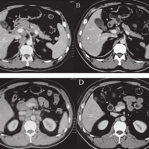 Ct Of The Abdomen Demonstrating Multiple Pathologically Enlarged