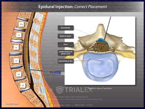 Epidural Injection Correct Placement Trialquest Inc