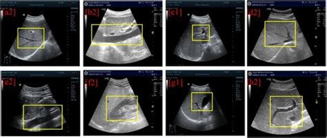 Full Article Automatic Classification Method Of Liver Ultrasound Standard Plane Images Using