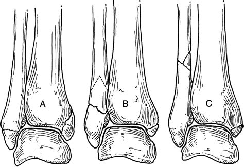 Weber Ankle Fracture Classification Emcage