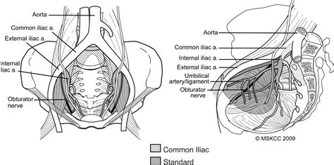 Extended Pelvic Lymph Node Dissection in Robotic-assisted Radical Prostatectomy: Surgical ...