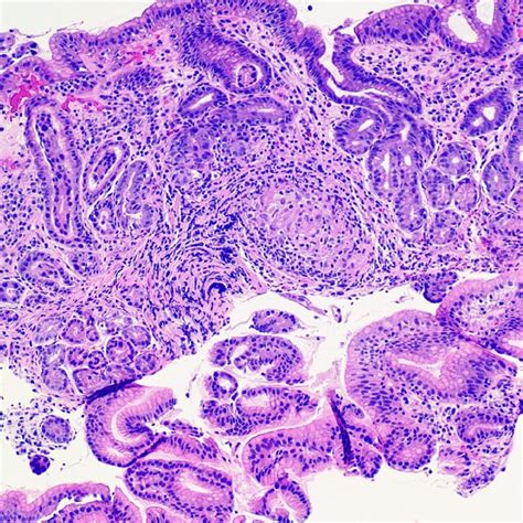 Stomach High Magnification One Noncaseating Granuloma Made Up Of A