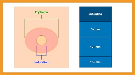 Ppd Test Induration Measurement