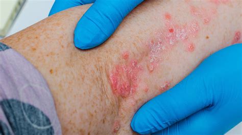 Psoriasis Elbow