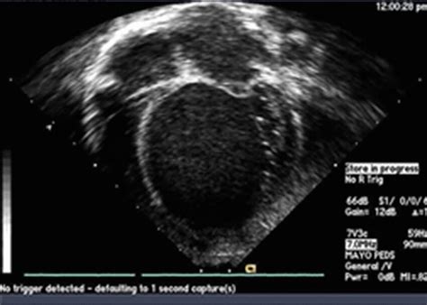 Echocardiogram Demonstrating Dilated Cardiomyopathy An Apical Download Scientific Diagram