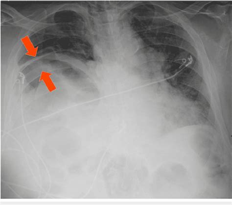 Chest Radiography Shows Marked On Elevation Of The Right Hemidiaphragm Download Scientific