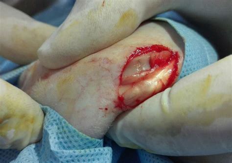 Photographs Show The Full Thickness Articular Cartilage Defect Created