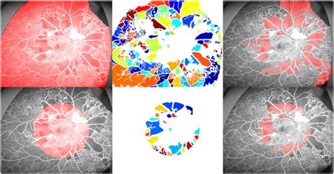 assessment of nonperfusion area npa on ultra widefield fluorescein
