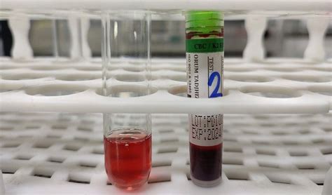 Negin Kamel Moghaddam On Linkedin A1c Hemoglobin A1c Or Hba1c Test 💉 The A1c Test Is A